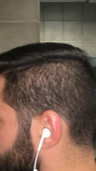 Do I Have Dupa Diffuse Unpatterned Alopecia Photos Doctor Answers Tips