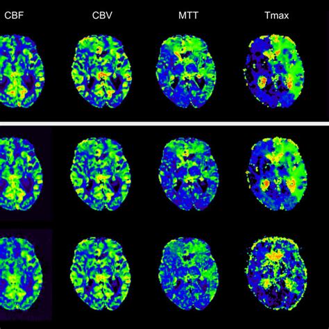 Synthesized Perfusion Parameter Maps Middle And Bottom Row Compared