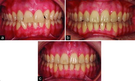 A Very Mild Class Ii Div 2 Malocclusion A C With Mild To Moderate