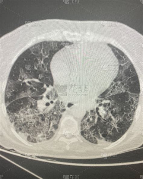 新型冠状病毒肺炎胸部ct扫描