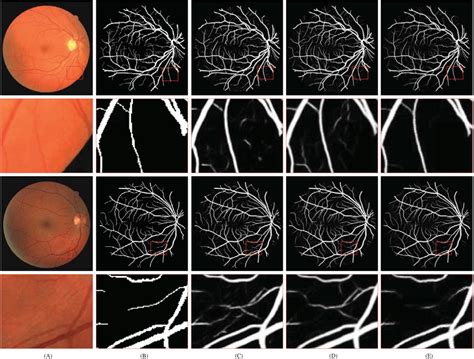 Examples Of Segmentation Results On Drive A Color Fundus Images B