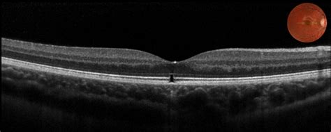 Laser Pointer Maculopathy Retina Image Bank