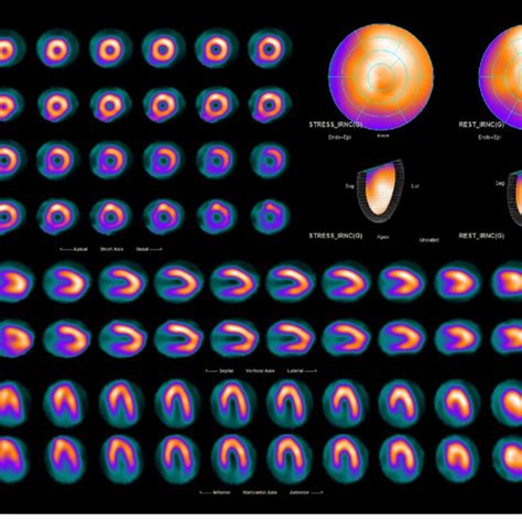 Follow Up Mpi Perfusion At Stress And Rest Of 99m Tc Myoview No Download Scientific Diagram