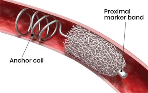 Devicemd Impede Embolization Plug