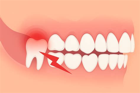 Why Wisdom Tooth Pain Can Spread To Your Front Teeth