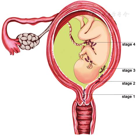 Diagnosis And Management Of Intraamniotic Infection Maternal Fetal