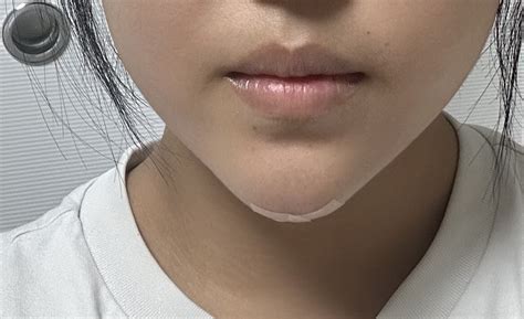 의사에게 물어보세요 오늘 턱끝 필러 0 강남언니 1등 성형수술and피부시술 정보앱