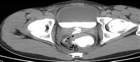 Rectal Impalement With Bladder Perforation A Review From A Urology Annals