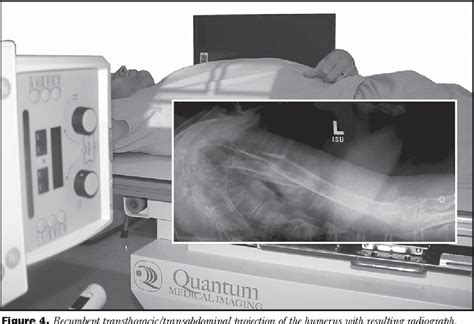 Figure From Imaging Humeral Fractures Semantic Scholar