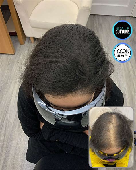 Photo Gallery Scalp Culture