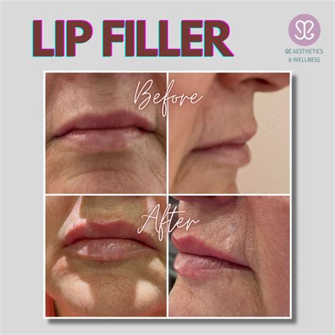 Dermal Fillers Restylane Juvederm Radiesse Lipfillers