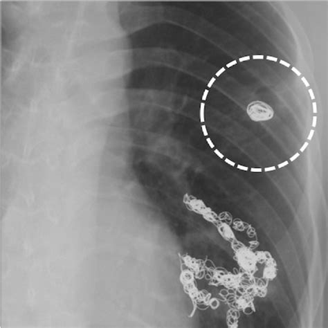 Chest Radiograph Images During Follow Up Showed That The Coils Used In Download Scientific
