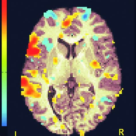 First Level Analysis Subject Level Exemplary Image Of Left Ba44