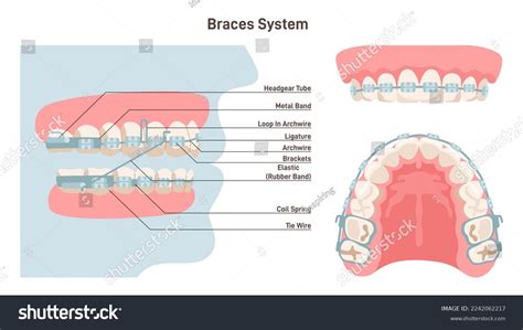 Dental Braces System Installed Brackets System Stock Vector Royalty Free 2242062217 Shutterstock