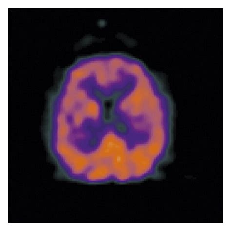 mr t2 spect medical image fusion results a mr t2 original image b