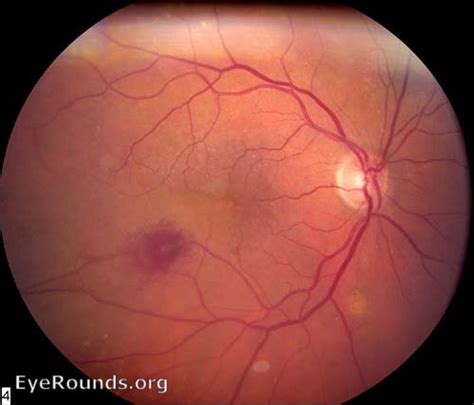 Retinal Arterial Macroaneurysm Rama Online Ophthalmic Atlas