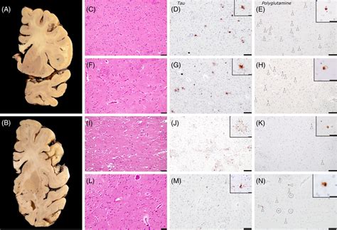 Neuropathological Analysis Of Cag Htt Pathological Expansion Carriers A Neuropathological Analysis Of Cag Htt Pathological Expansion Carriers A