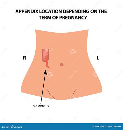 The Location Of The Appendix Depends On The Term Of Pregnancy 5 6