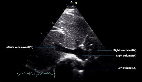 Echo Basics Apical And Subcostal Views • Litfl • Radiology Library Echo Basics Apical And Subcostal Views • Litfl • Radiology Library
