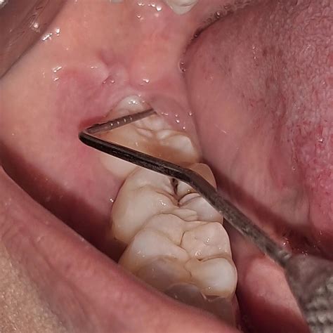 Dr Akriti Mishra On Linkedin Operculectomy Is A Minor Surgical