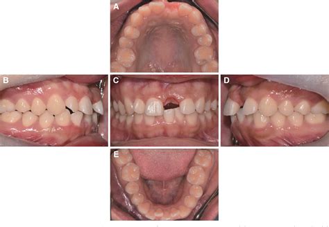 Figure 1 From Esthetic Anterior Restoration Using 3m Lavatm Esthetic Monolithic Zirconia