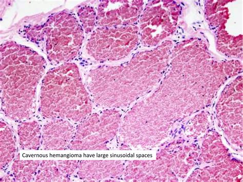 Lecture Vertebral Hemangioma Of The Spine Pptx