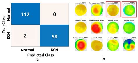 A Deep Feature Fusion Of Improved Suspected Keratoconus Detection With