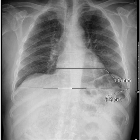 Pdf Brevibacterium Luteolum Bacteremia A Case Report And Literature