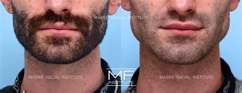 Defined Jawline In Males Mens Jawline Filler And Contouring Cosmetic