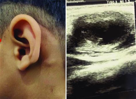 A Well Defined Nodular Swelling In The Left Retro Auricular Region
