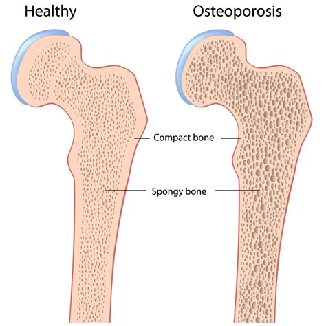 Brittle Bone Disease Vs Osteoporosis At Dorothy Bufkin Blog