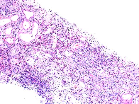 Interstitial Inflammation With Prominent Eosinophils Low Power Nephsim
