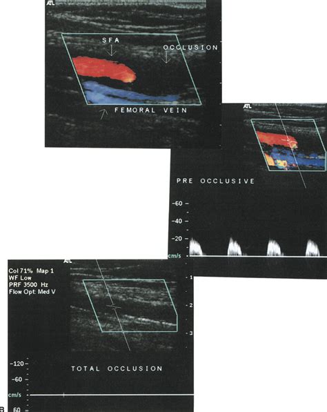 Duplex Evaluation Of Lower Extremity Arterial Occlusive Disease Thoracic Key