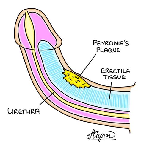 Peyronies Disease Peyronies Disease Still A Surgical Disease