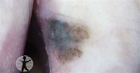 Acral Lentiginous Melanoma Dermoscopy Image