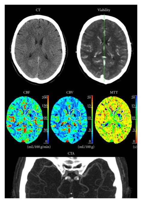 Case 3 49 Year Old Male With Right Sided Stroke Symptoms And A Normal