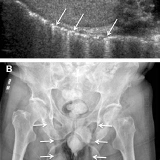 Chronic Scrotal Wall Edema In A Patient With Congestive Heart Failure Download Scientific