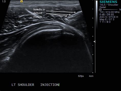 Shoulder Arthrogram Injection