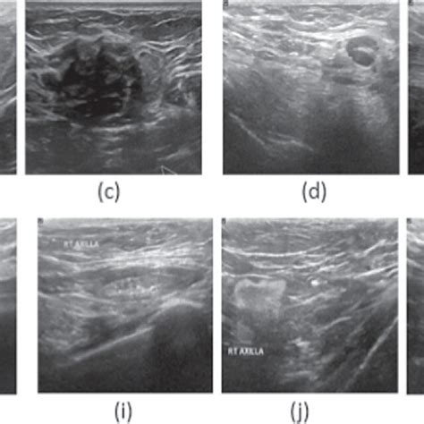 Dataset 1 Busi Outliers Af Incorrect Lesion Labels Ac