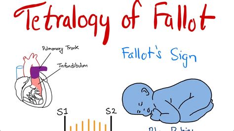 Tetralogy Of Fallot Pathogenesis Signs And Management Everything You Need To Know YouTube