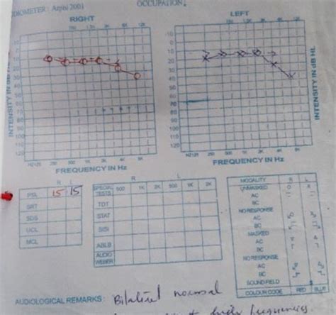 Normal Bilateral Audiologic Evaluation Download Scientific Diagram