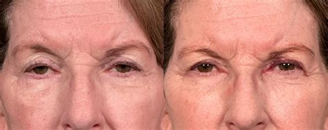 89 Eyelid Center Of Utah