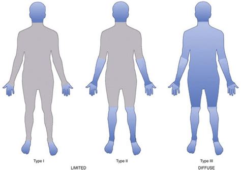 Clinical Features And Treatment Of Scleroderma Musculoskeletal Key