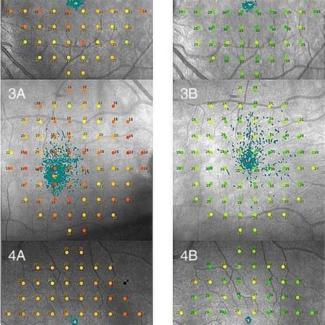 A Simulated Image Of A Logmar Visual Acuity Test Is Shown Without A Download Scientific