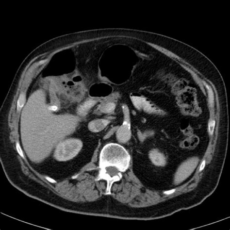 Subhepatic Appendicitis With Faecolith In Situ Download Scientific Diagram