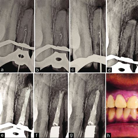 Pdf Internal Tunneling Resorption Associated With Invasive Cervical Resorption