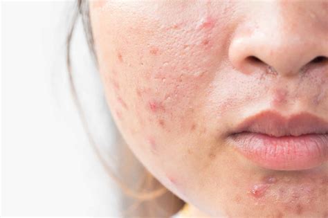 Acne Rosacea Chin