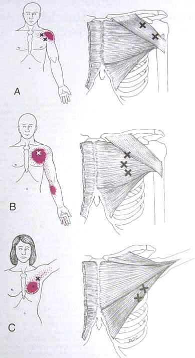 Relieve Tension With Pec Maj Trigger Point Diagram