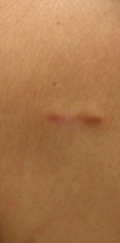 Patient 14833 Keloid Before And After Photos Santa Monica Plastic