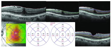 Example Of Retinal Layer Segmentation Upper Row Preoperative Images Download Scientific